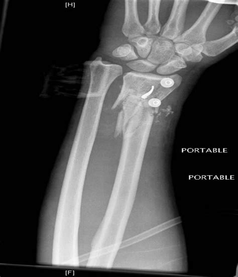 Distal Radius Fractures Trauma Orthobullets