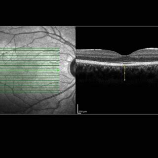 OCTA Image Processing In Image J A Transverse Image Of Superficial Download Scientific