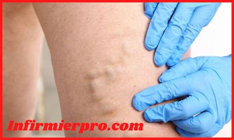 Thrombophlébite Signes Traitement Prévention Infirmier Pro