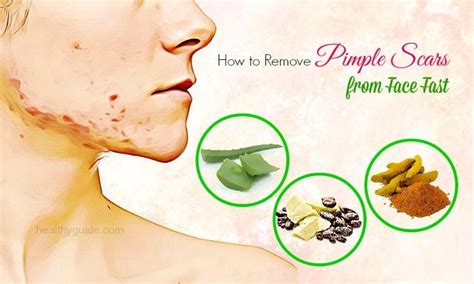 Tips How To Remove Pimple Scars On Nose Chest Back Legs Fast