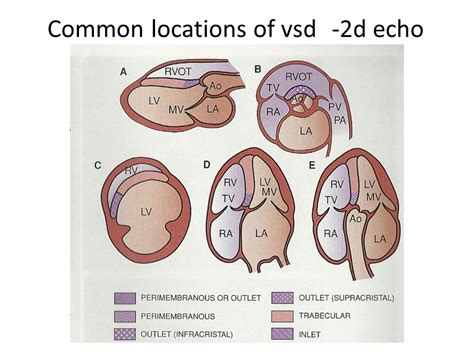 Cardiac Sonography Ventricular Septal Defect Outlet Heart Defect Mcat Medical Information