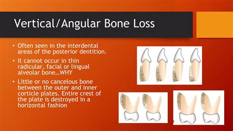 Radiographic Examinations Of Bone Loss And Pattern Of Bone Loss Pptx