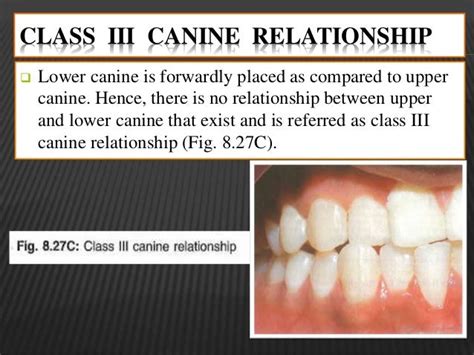 Classification Of Malooclusion