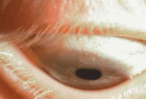 Vernal Keratoconjunctivitis Ento Key