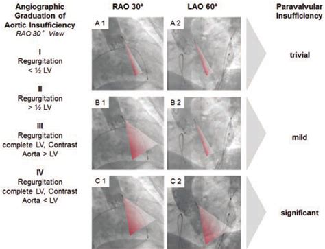 Modified Angiographic Grading Of Aortic Regurgitation Conventional