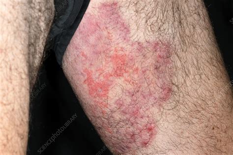 Groin Rash In Men
