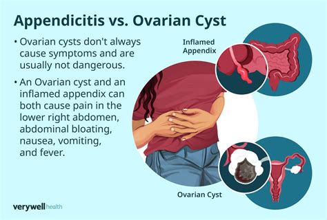 Left Ovarian Cyst Symptoms