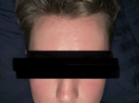 Doxycycline 100mg R Rosacea