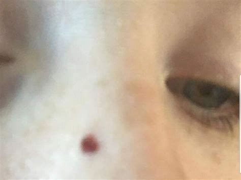 Spot Scab On Nose