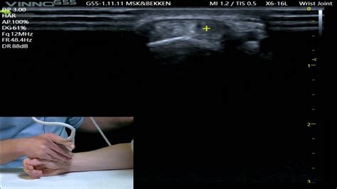 2 Echografie Pols 1e Loge Apl Epb Dwars Youtube