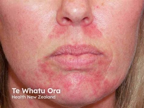 DermNet Periorificial Dermatitis Perioral Dermatitis Authoritative Guidance DermNet