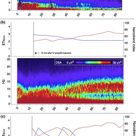 pdf electroencephalographic eeg density spectral array monitoring