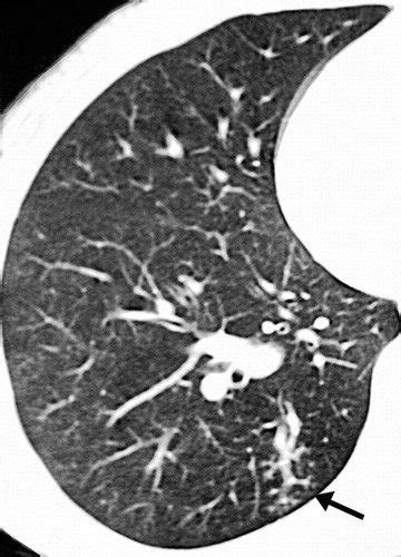 Tree In Bud Sign Lungs
