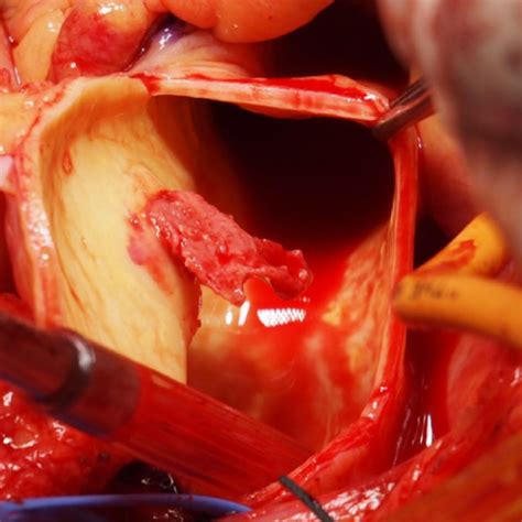 Aortotomy Showing The Thrombus In The Ascending Aorta Pathological