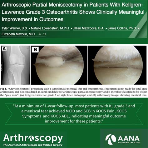 Arthroscopy Journals On Linkedin Ortho Orthopaedic Medicine Sportsmedicine Arthroscopy
