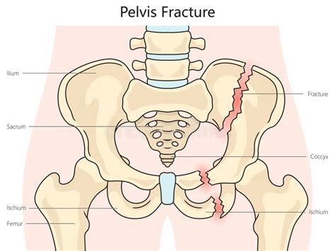 Pelvic Fracture Structure Diagram Medical Science Stock Vector