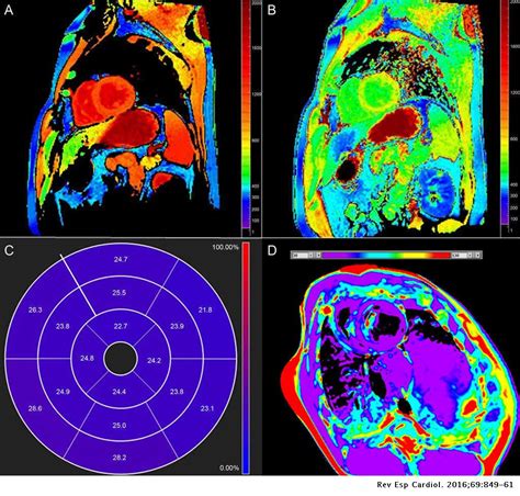 myocardial mapping with cardiac magnetic resonance the diagnostic
