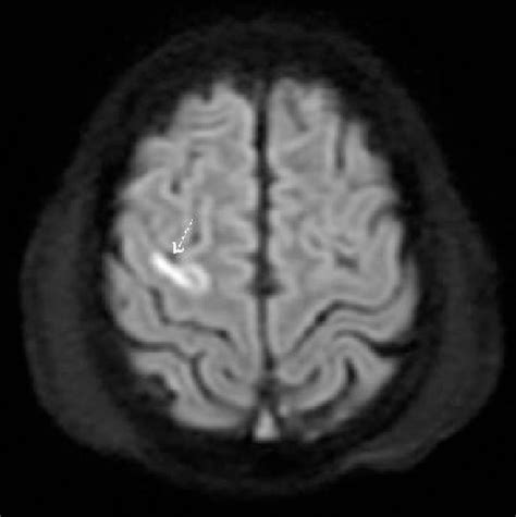 Magnetic Resonance Imaging Brain Showing Area Of Diffusion Restriction