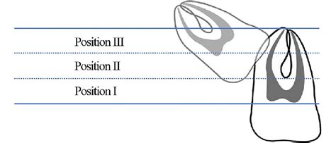 Tooth Position Classification Based On The Relative Impaction Depth