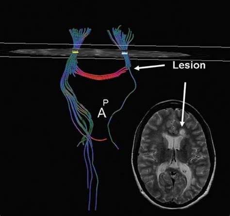 Applications Of Diffusion Tensor Imaging And Fiber Tractography Applied Radiology