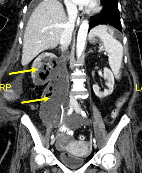 Emphysematous Pyelonephritis Radiology Cases