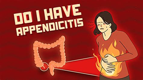 Appendicitis Quiz Do You Have Appendicitis 15 Signs