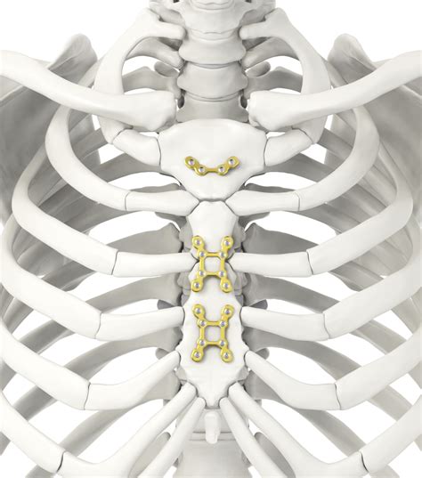 Sternal Plating System Sternum Fixation Tradekorea Sternal Plating System Sternum Fixation Tradekorea