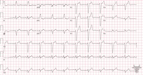Left Bundle Branch Block ECG Stampede