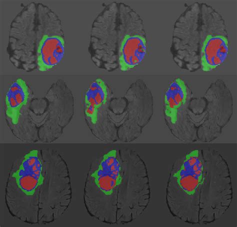 Figure 4 From Pure Versus Hybrid Transformers For Multi Modal Brain