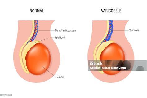 Varicocele Vector Comparison Of Normal Testicular Vein And Varicocele
