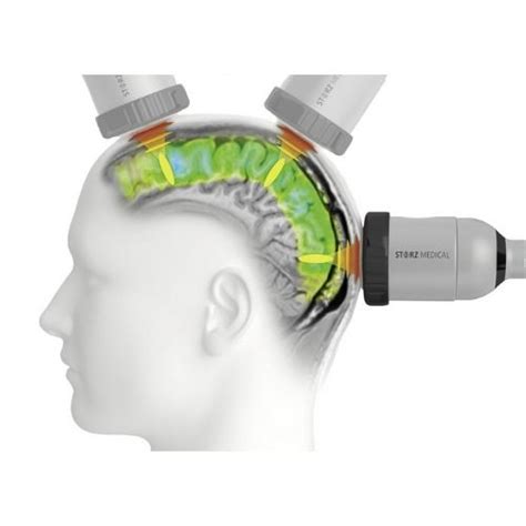Transcranial Pulse Stimulation A New Drug Free Treatment For Alzheimers Venn Healthcare
