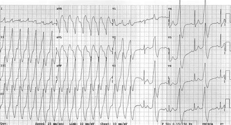 Ventricular Bigeminy Symptoms
