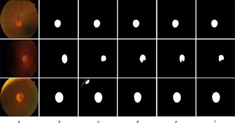 segmentation results with different adversarial networks on drishti‐gs