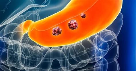 Votre Groupe Sanguin Pourrait Influencer Vos Risques De Cancer