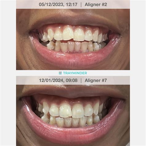 5 Week Progress R Invisalign