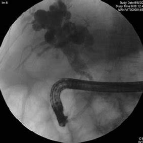 ERCP With Biliary Plastic Stent Placement In Patient With Common Bile Download Scientific