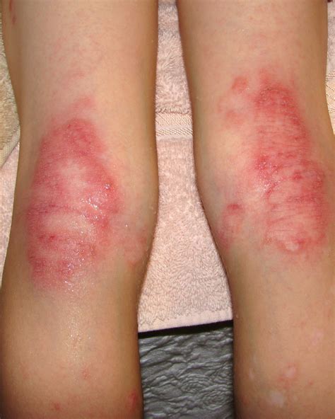 Staph Infection Early Stages Rash