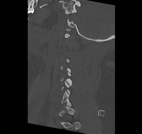 Differential Diagnosis Of Infographic CT Cervical Spine Interpretation