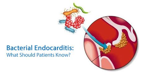 Bacterial Endocarditis And Heart Valve Infections
