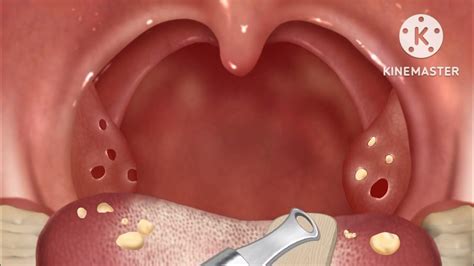 Tonsil Stoneremoval Animation Youtube