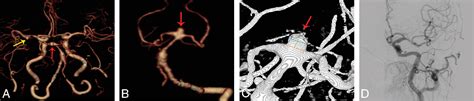 Figure 2 From Of Intracranial Aneurysms Low Contrast Material Volume