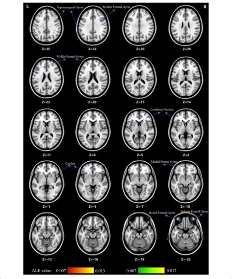The Gray Matter Reduction Red And Increase Green In Ocd Based On