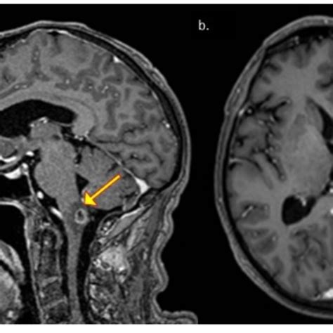 Cryptoccocomas By Cryptococcus Gatti A Post Gadolinium Sagittal T1 Download Scientific