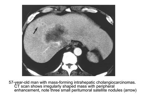 Diagnostic Imaging Of Cholangiocarcinoma Ppt Digestive Disorders