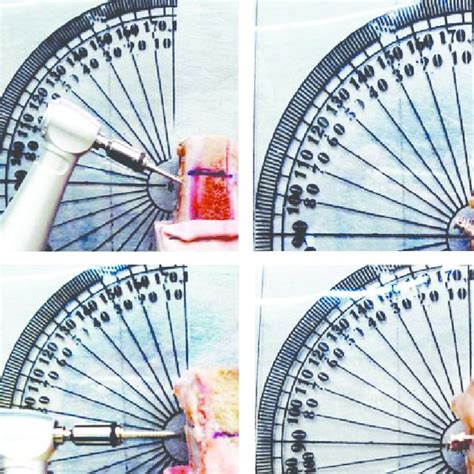 Protractor Used To Guide Mini Implant Placement Download Scientific Diagram