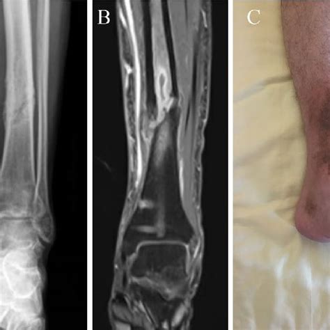 Case 1 Masquelet Procedure Stage 1 Download Scientific Diagram