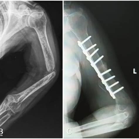 Tendon Transfer Procedure Using Modified Jones Procedure A Pl Download Scientific Diagram