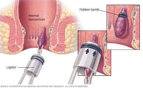Best 13 Hemorrhoidsdifferent Types Of Hemorrhoids Internal And