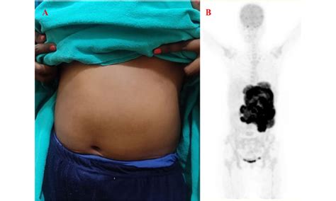 A 20 Year Old Female Presented With Left Sided Abdominal Distention