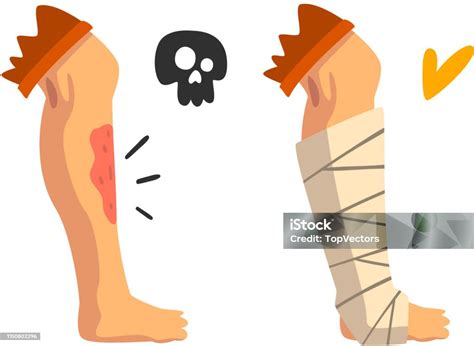 부상 다리 신체 부상 붕대 다리 응급 처치 및 치료 벡터 일러스트 레이 션 흰색 바탕에 개념에 대한 스톡 벡터 아트 및 기타 이미지 Istock